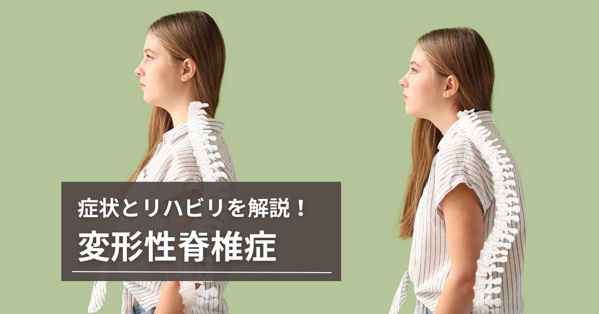 変形性脊椎症のリハビリを現役理学療法士が解説
